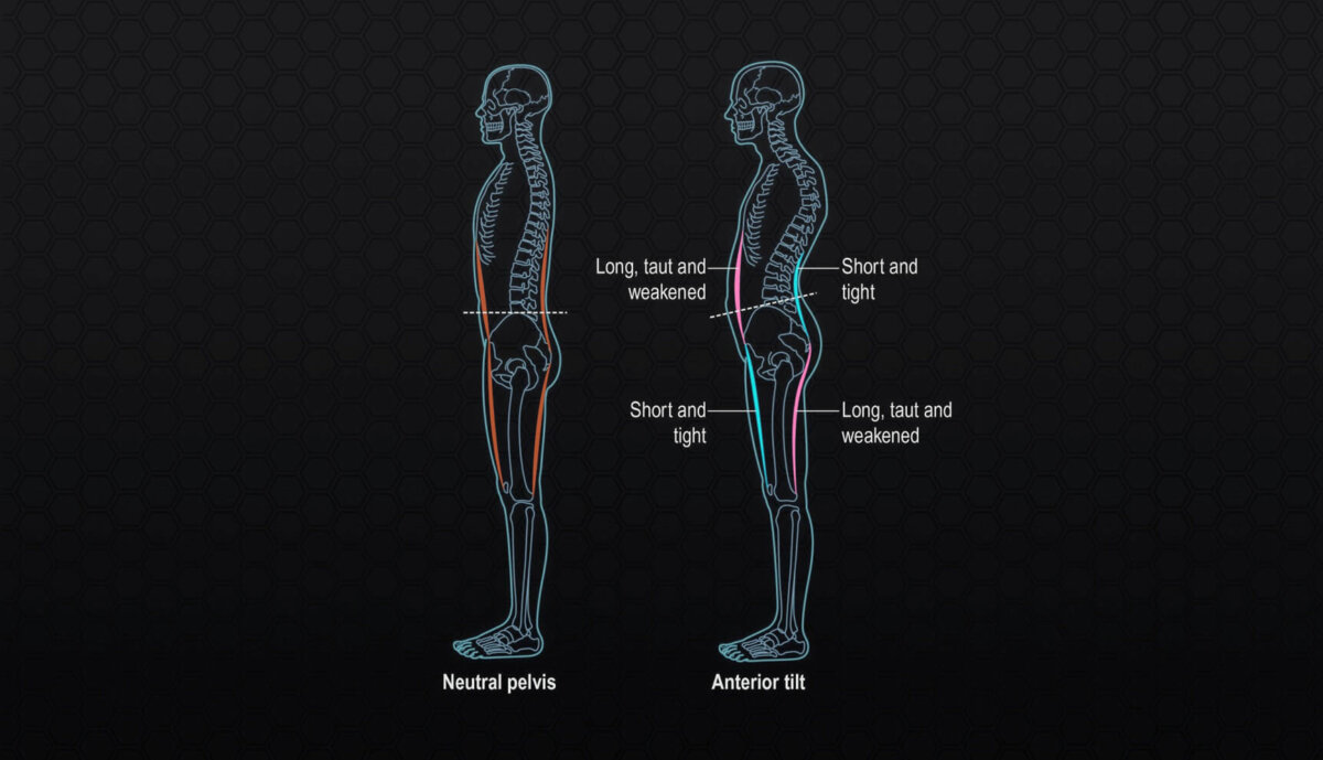 Training Options for Anterior Pelvic Tilt | Biolayne